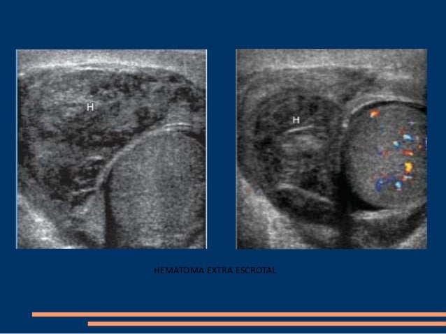 Ecografia testicular