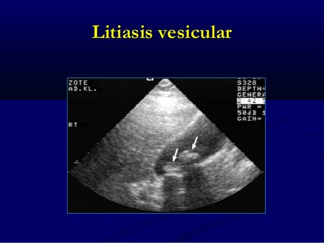Ecografia vesicula biliar