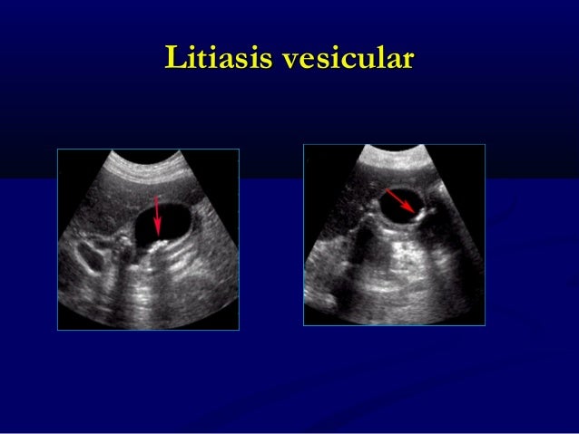Ecografia vesicula biliar