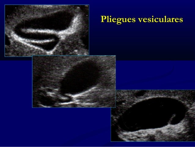 Ecografia vesicula biliar