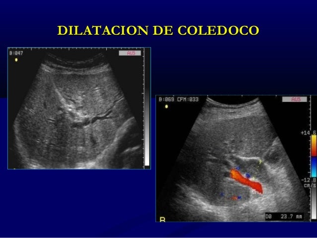 Ecografia vesicula biliar