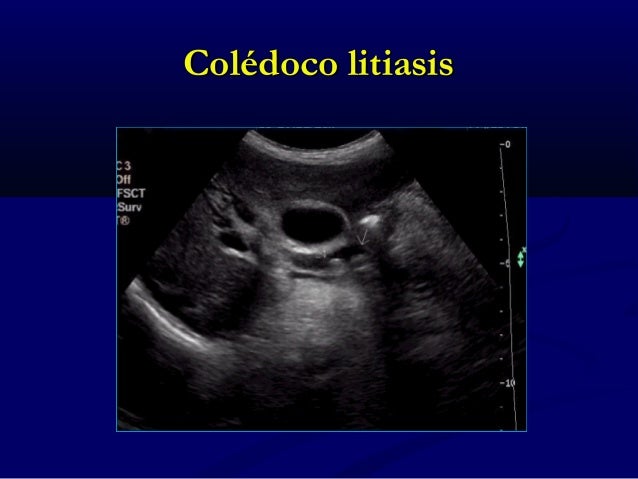 Ecografia vesicula biliar