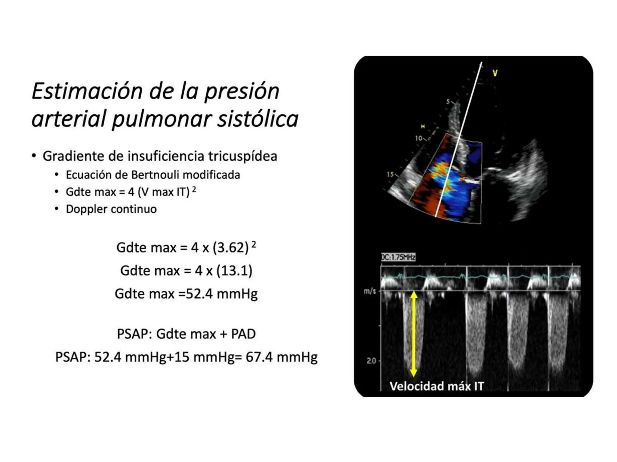 ECOCARDIOGRAFIA EN HIPERTENSIÓN PULMONAR.pptx
