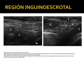 Ecografía inguinal. | PPTX
