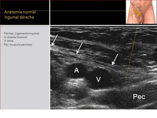 Ecografía inguinal. | PPTX