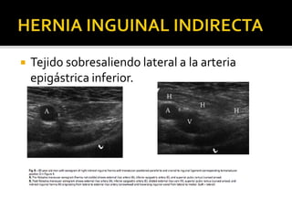 Ecografía inguinal. | PPTX