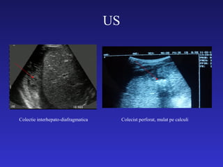 Ecografia interventionala in drenajul colectiilor abdominale | PPT