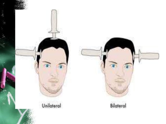 ELECTROCONVULSIVE THERAPY AND ITS NURSING MANAGEMENT, ECT | PPTX