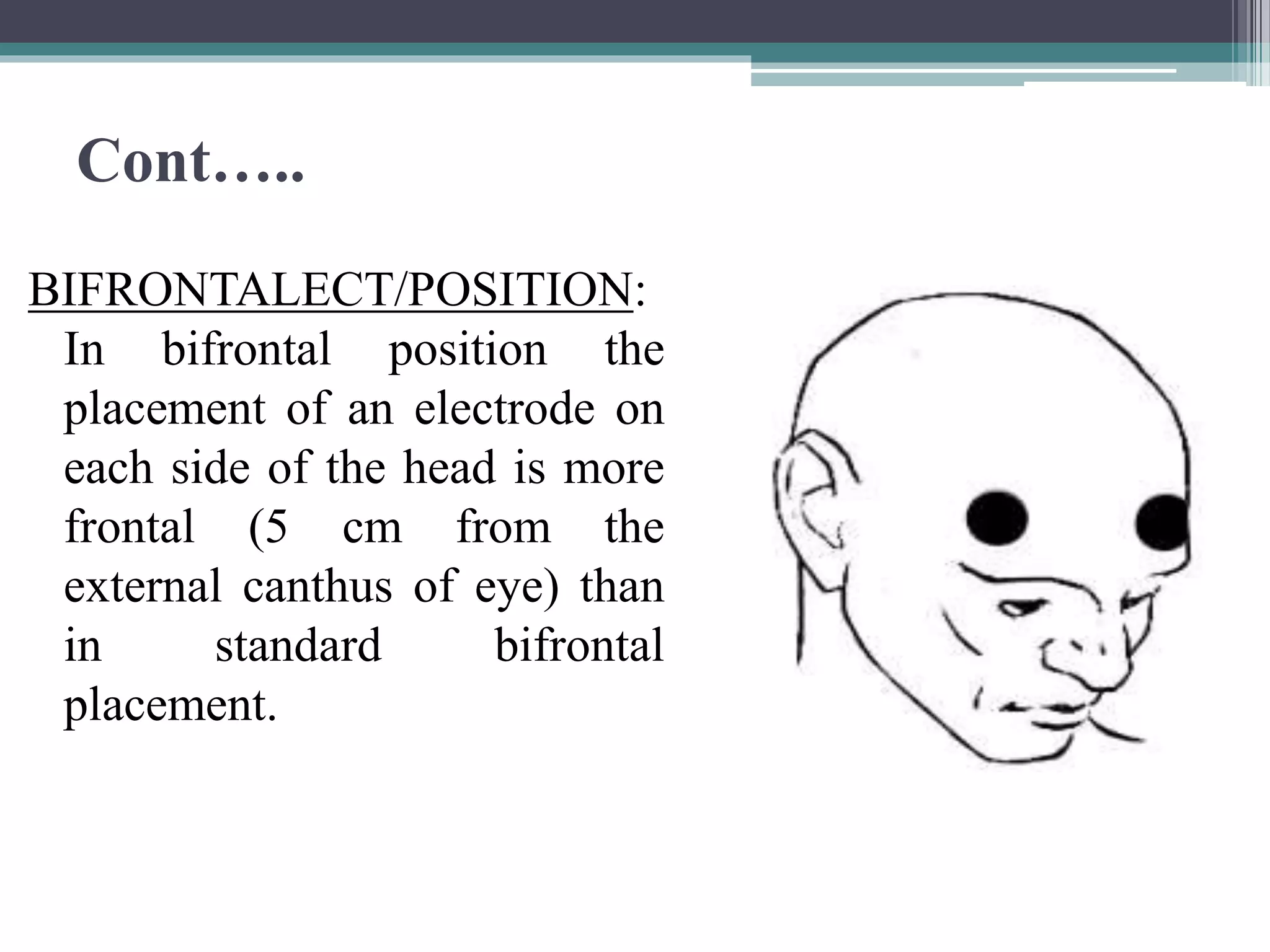 Electroconvulsive Therapy | PPTX