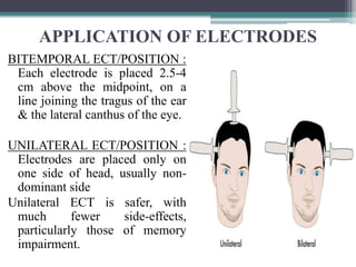 Electroconvulsive Therapy | PPTX