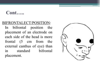 Electroconvulsive Therapy | PPTX