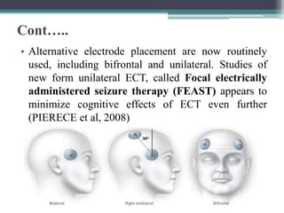 Placement Of Electrodes In Electroconvulsive Therapy