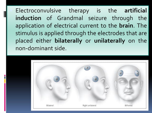 Electroconvulsive therapy (ECT) | PDF