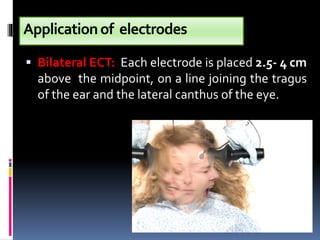 Electroconvulsive therapy (ECT) | PDF
