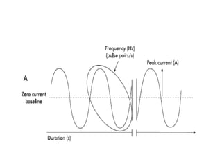 Ect electrical stimulus and procedure | PPT | Physical Therapy | Wellness