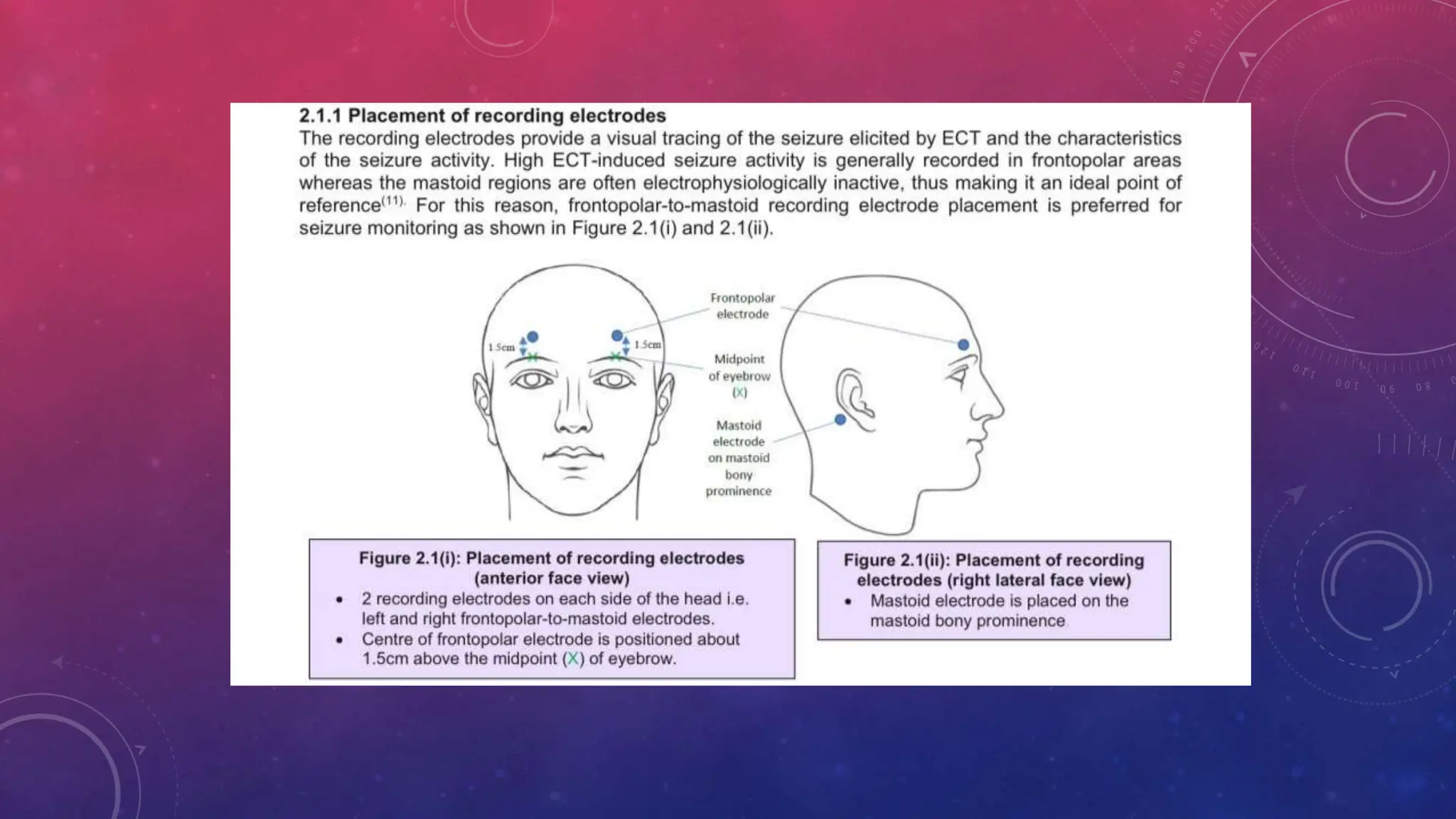ECT therapy and guidelines for trwatmentpptx | PPT