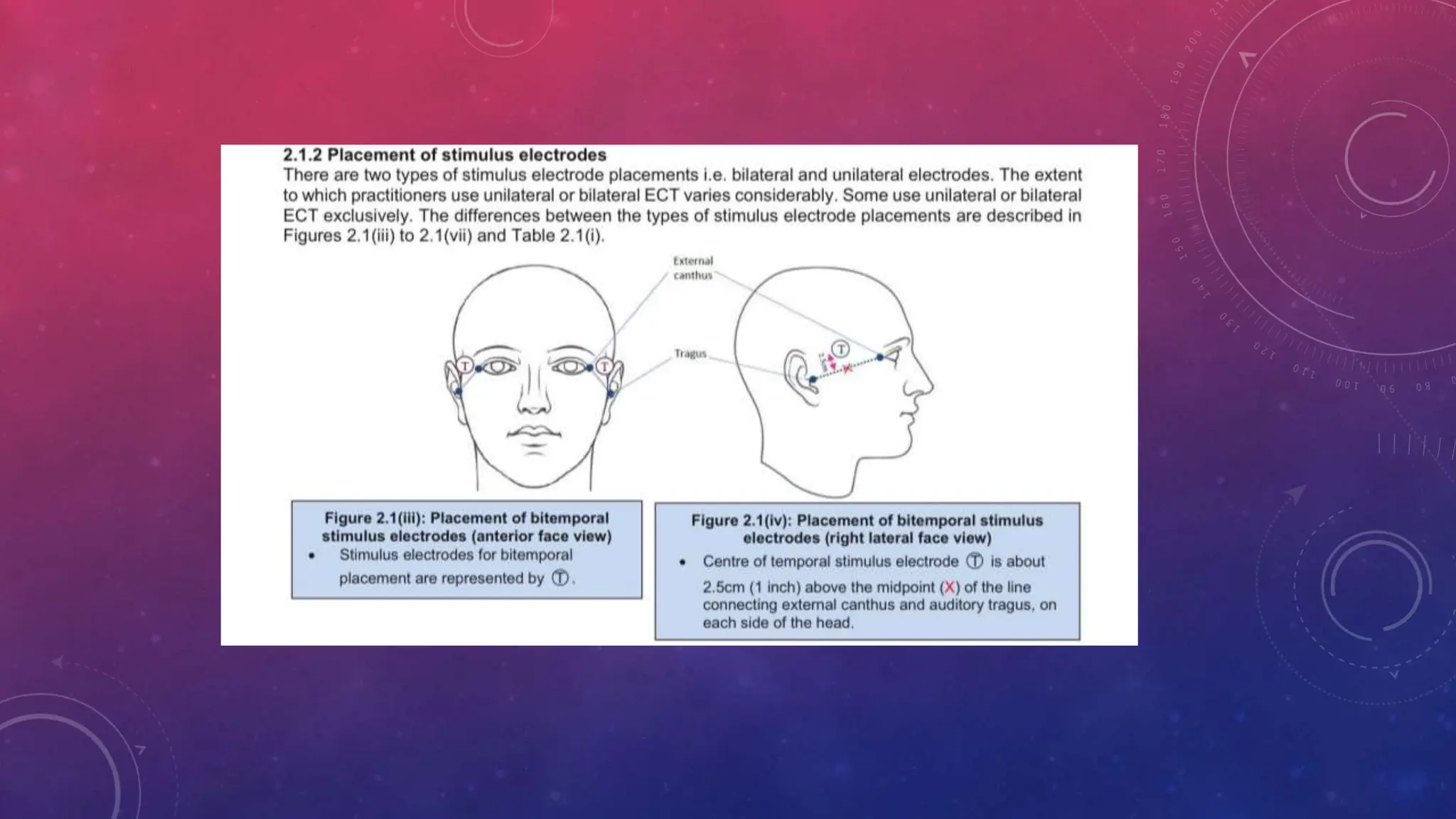 ECT therapy and guidelines for trwatmentpptx | PPT
