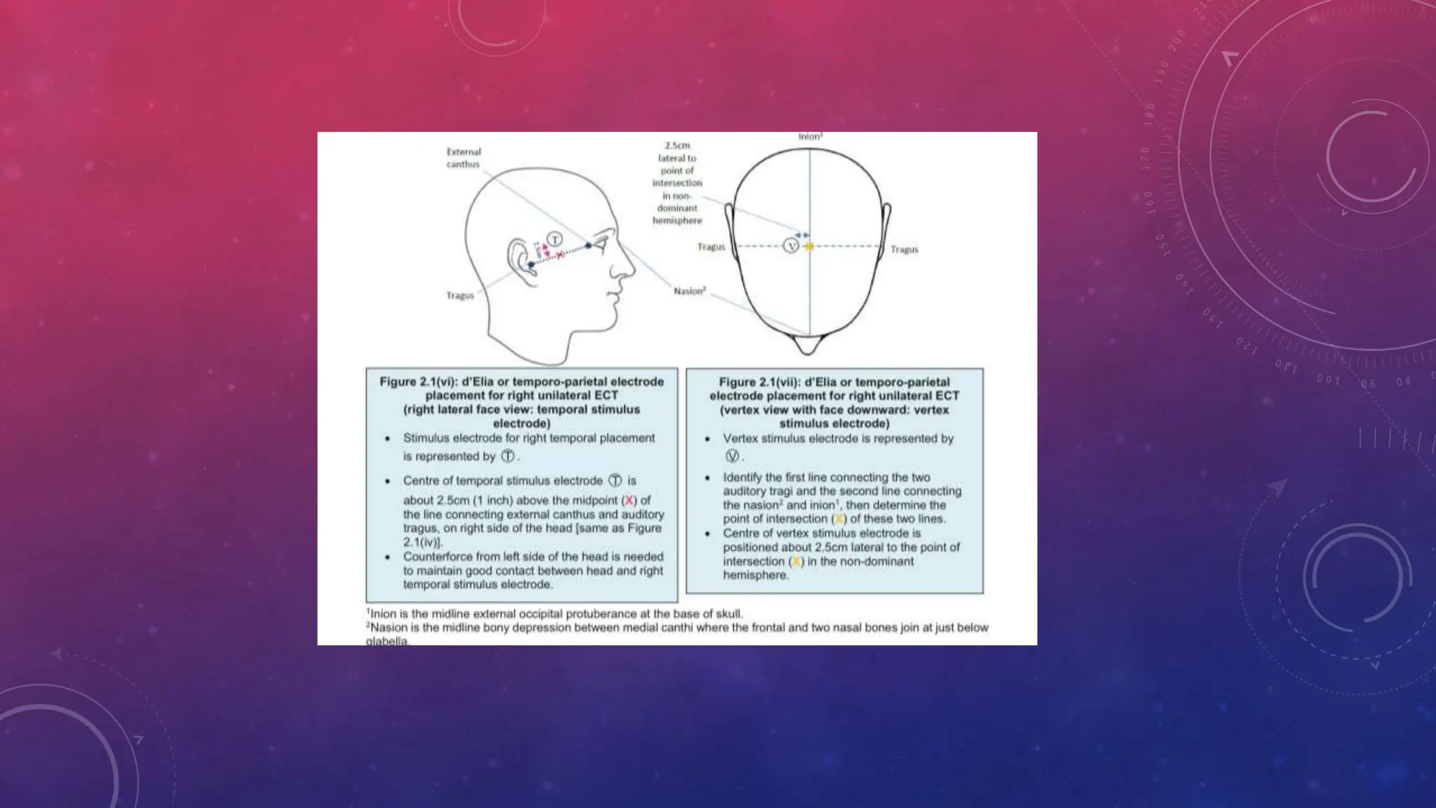 ECT therapy and guidelines for trwatmentpptx | PPT