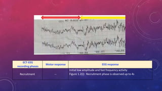 ECT therapy and guidelines for trwatmentpptx | PPTX