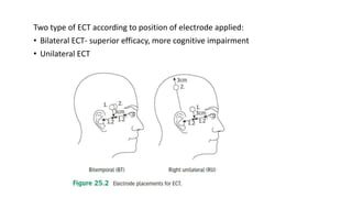 Electroconvulsive therapy | PPTX | Brain and Nervous System Disorders ...
