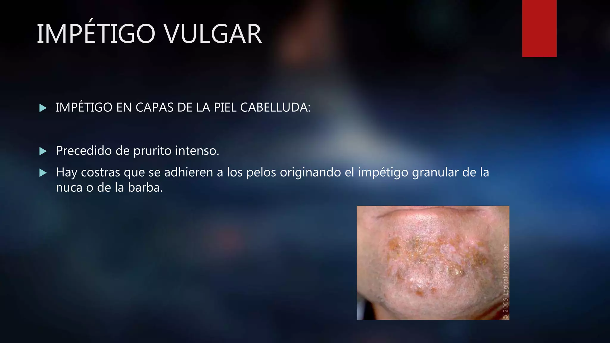 Ectima, eritrasma, hidrosadenitis, impetigo vulgar, folliculitis ...