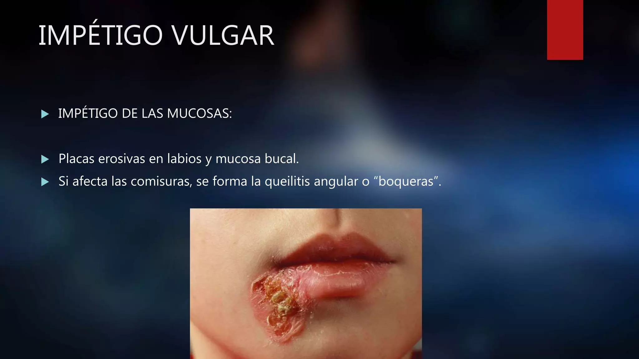 Ectima, eritrasma, hidrosadenitis, impetigo vulgar, folliculitis ...