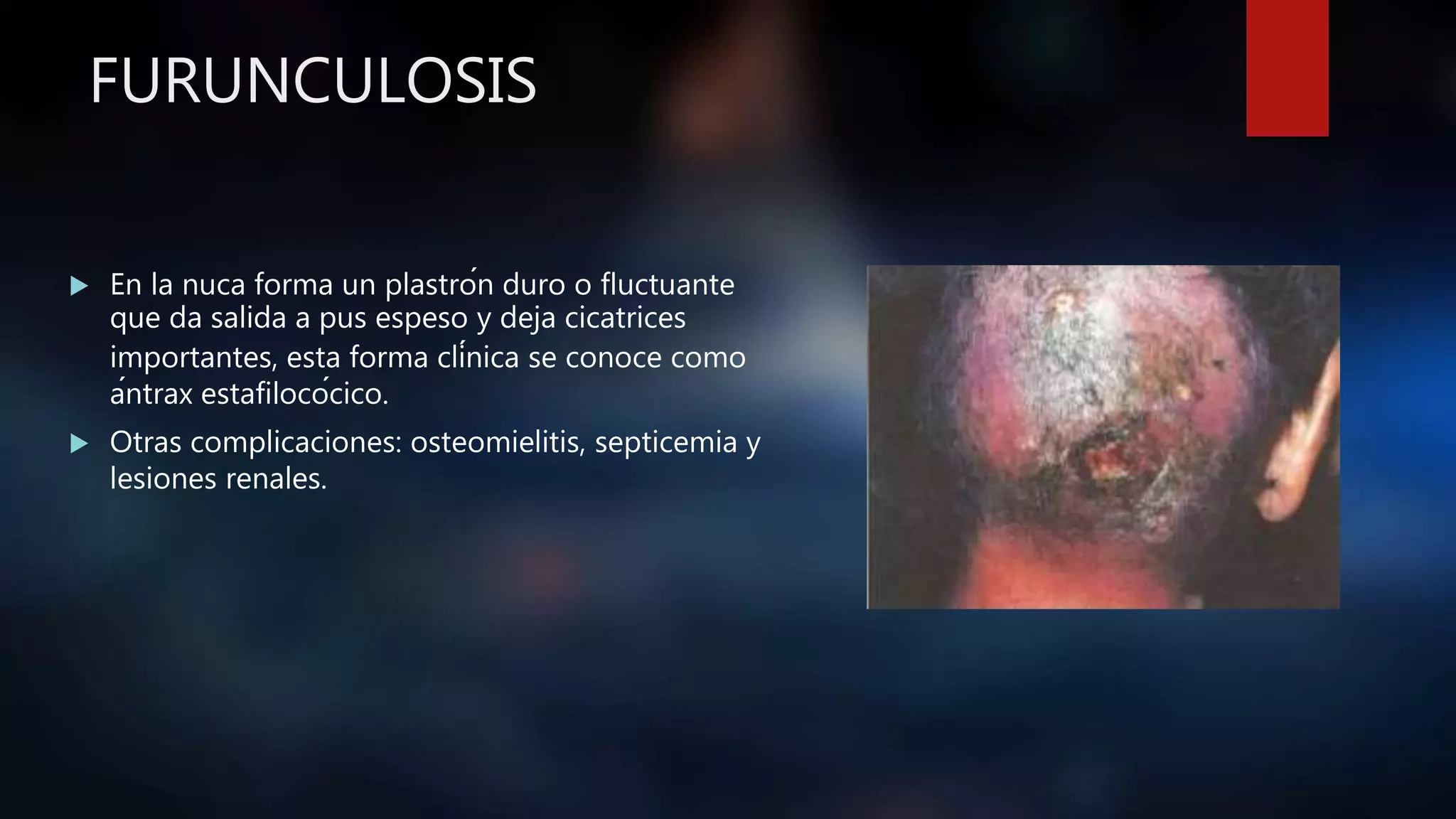 Ectima, eritrasma, hidrosadenitis, impetigo vulgar, folliculitis ...