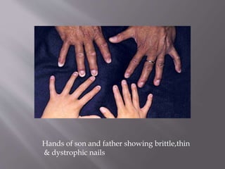 Hypohidrotic Ectodermal Dysplasia Hands