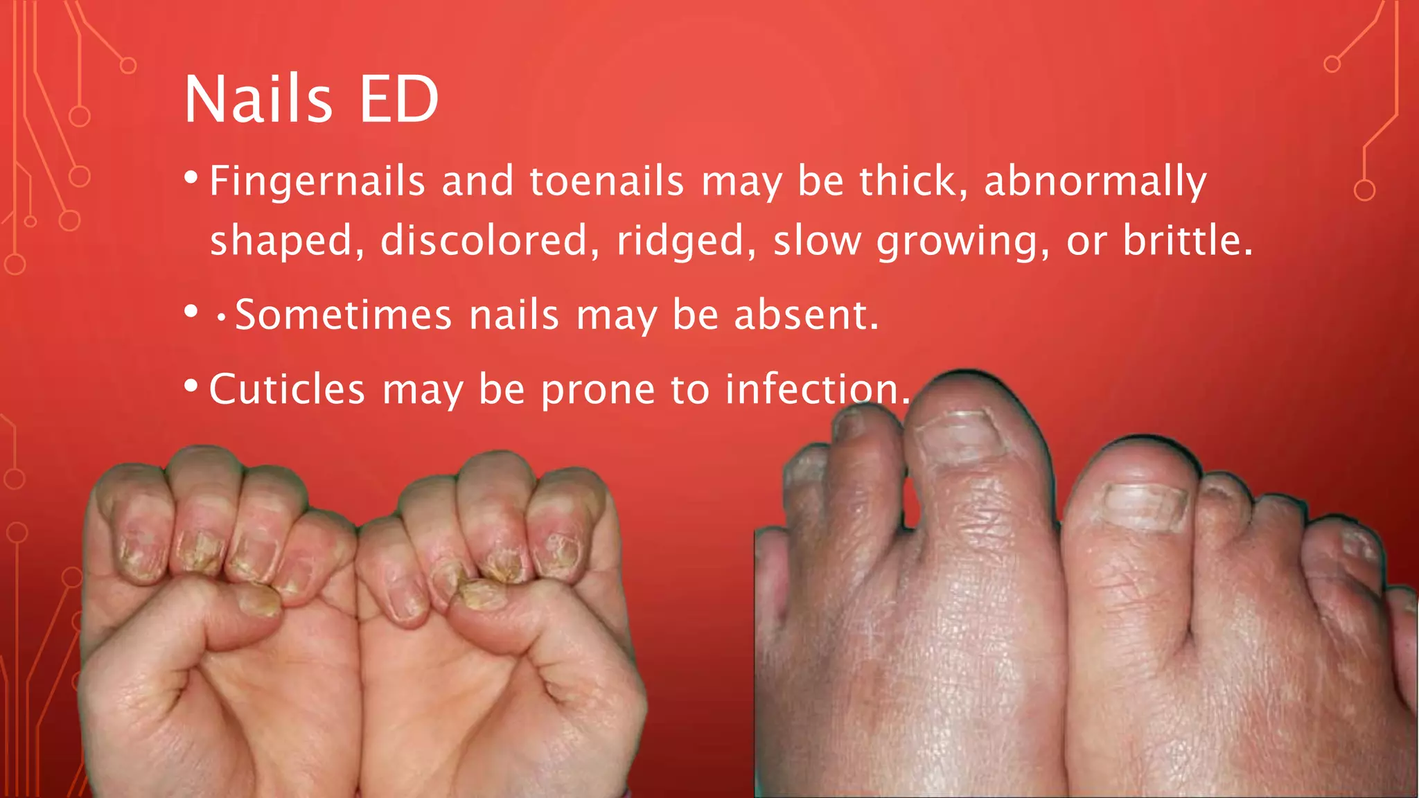 Ectodermal dysplasia | PPTX