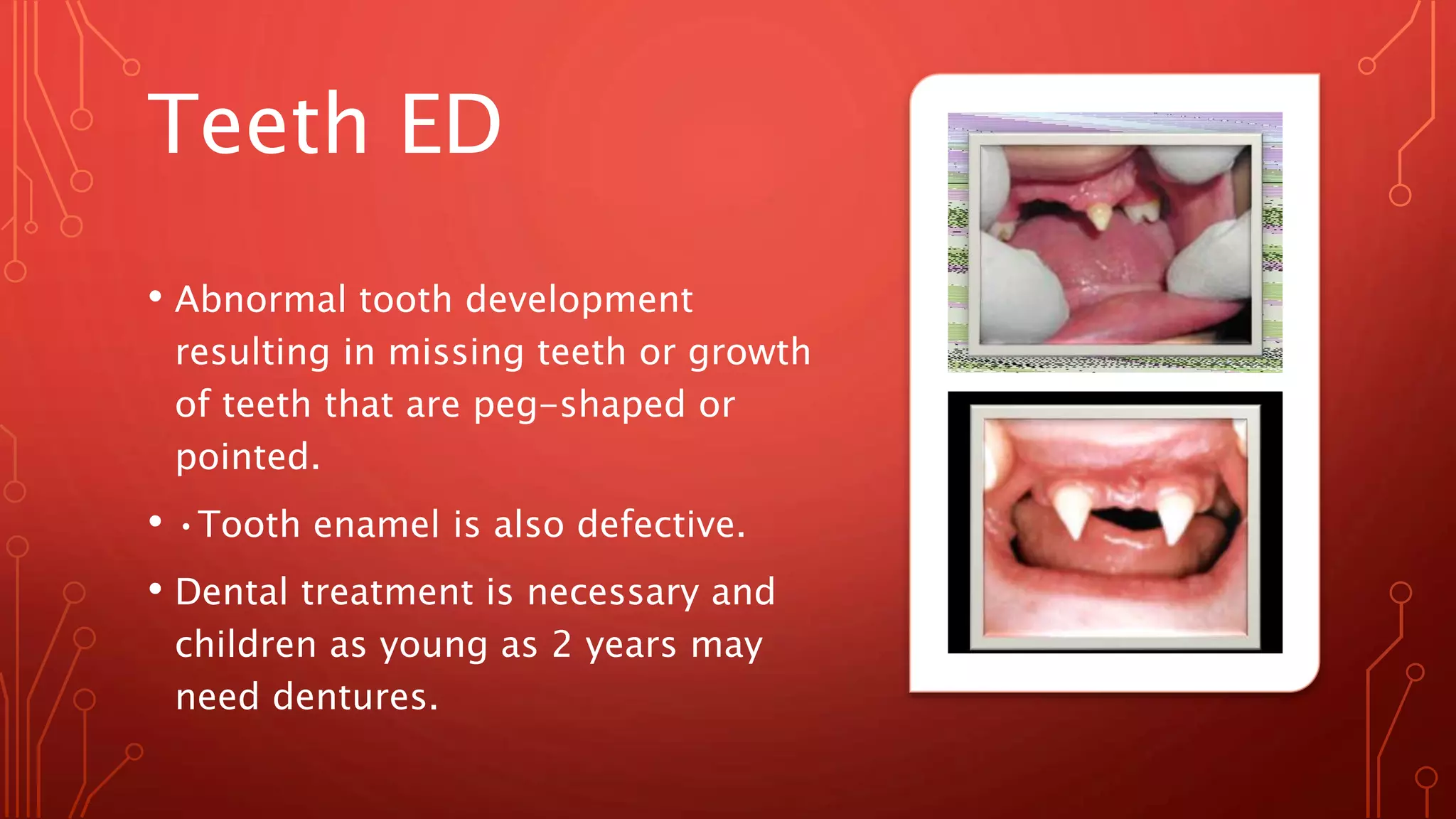 Ectodermal dysplasia | PPTX