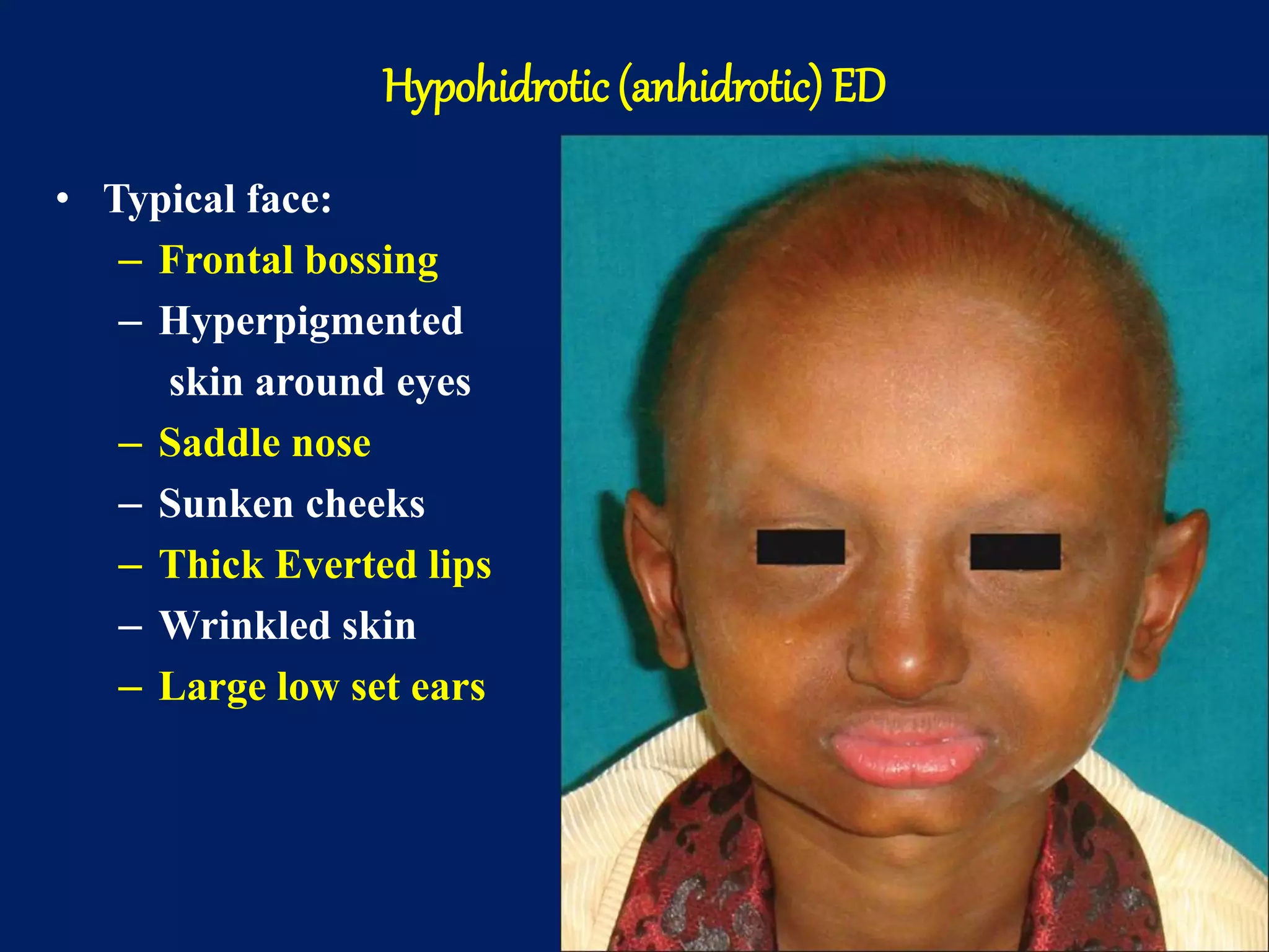 ectodermal dysplasia and white spongy nevus.ppt | Skin and Dermatology ...