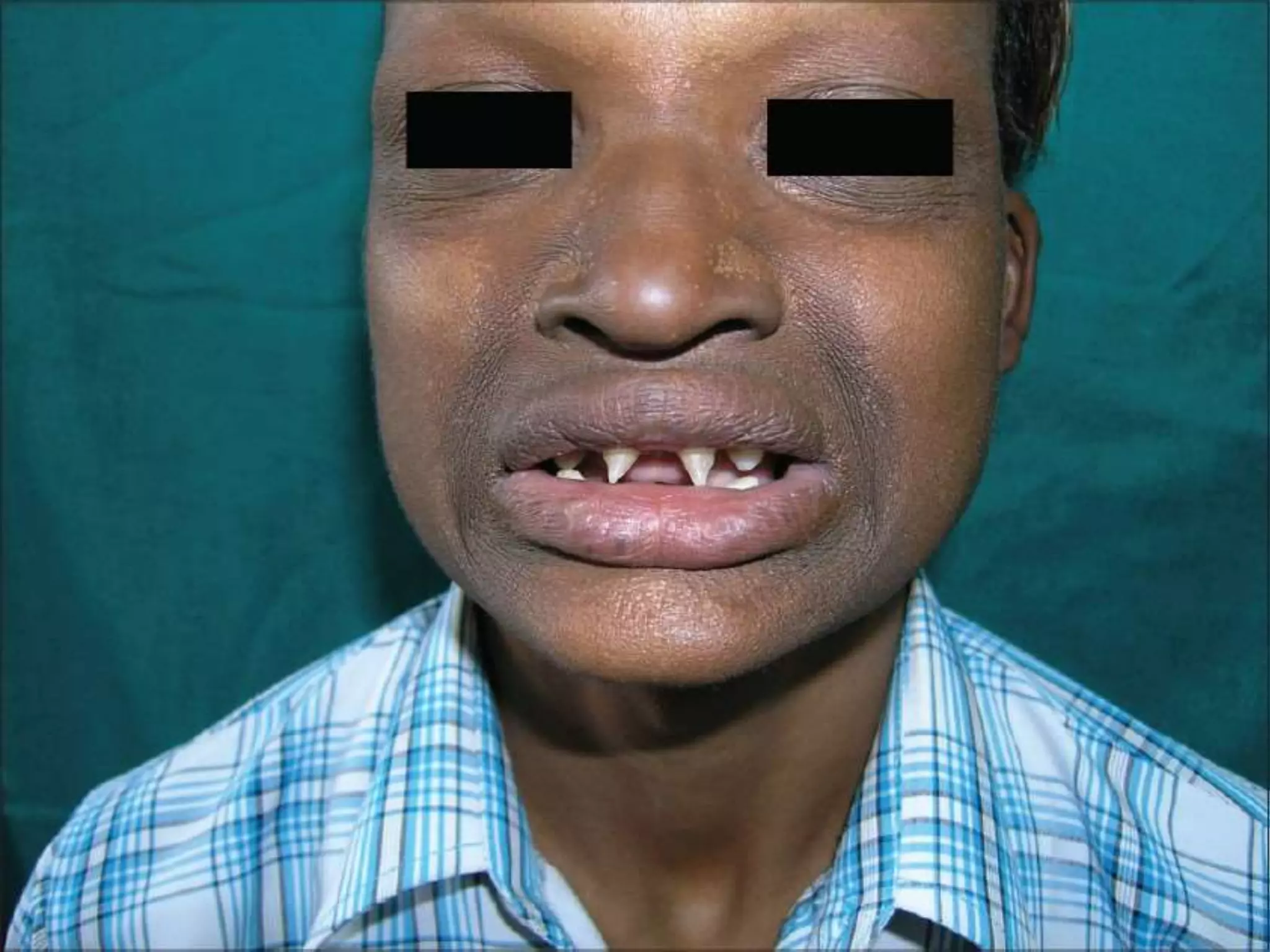 ectodermal dysplasia and white spongy nevus.ppt | Skin and Dermatology ...