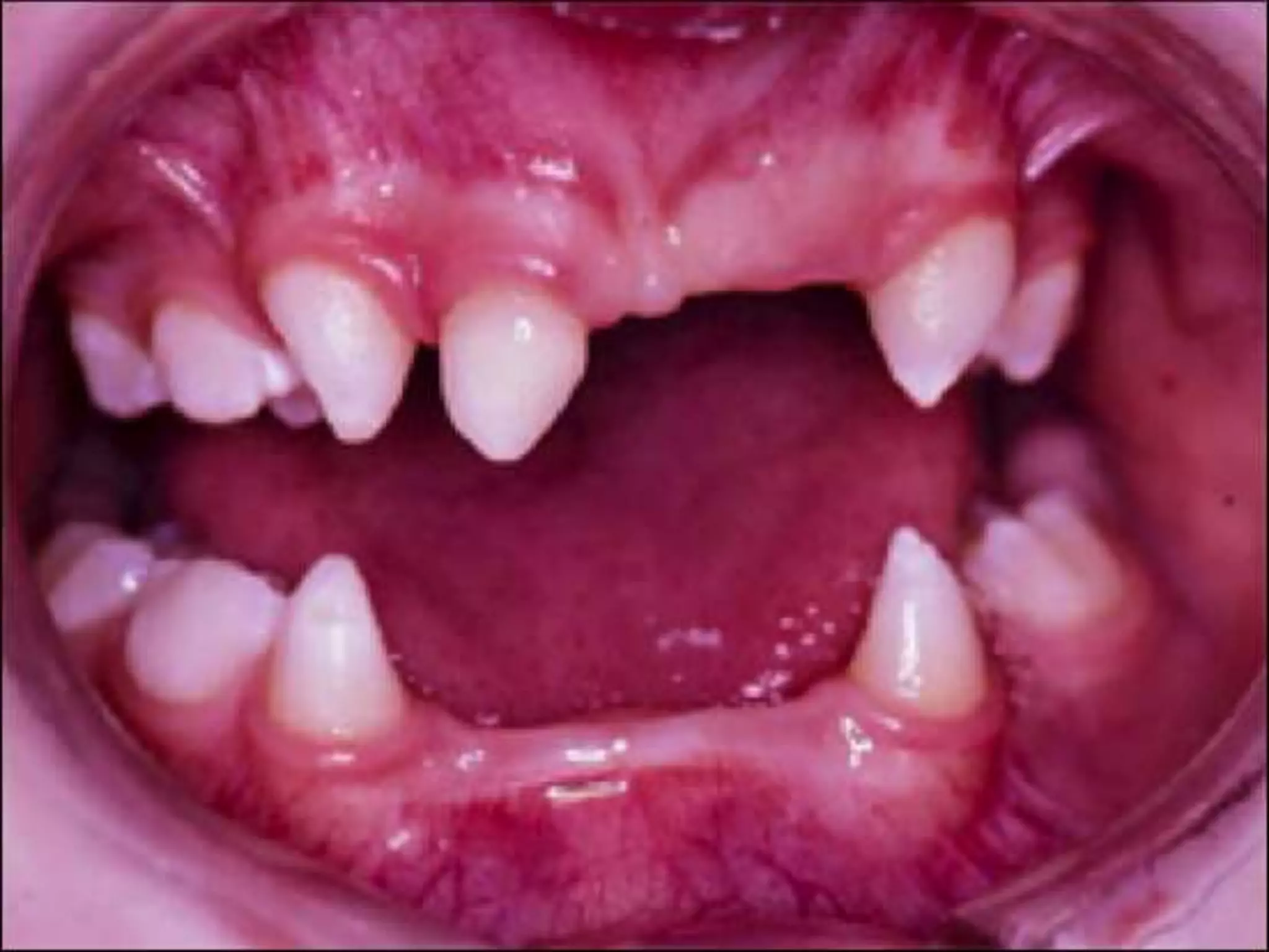 ectodermal dysplasia and white spongy nevus.ppt | Skin and Dermatology ...