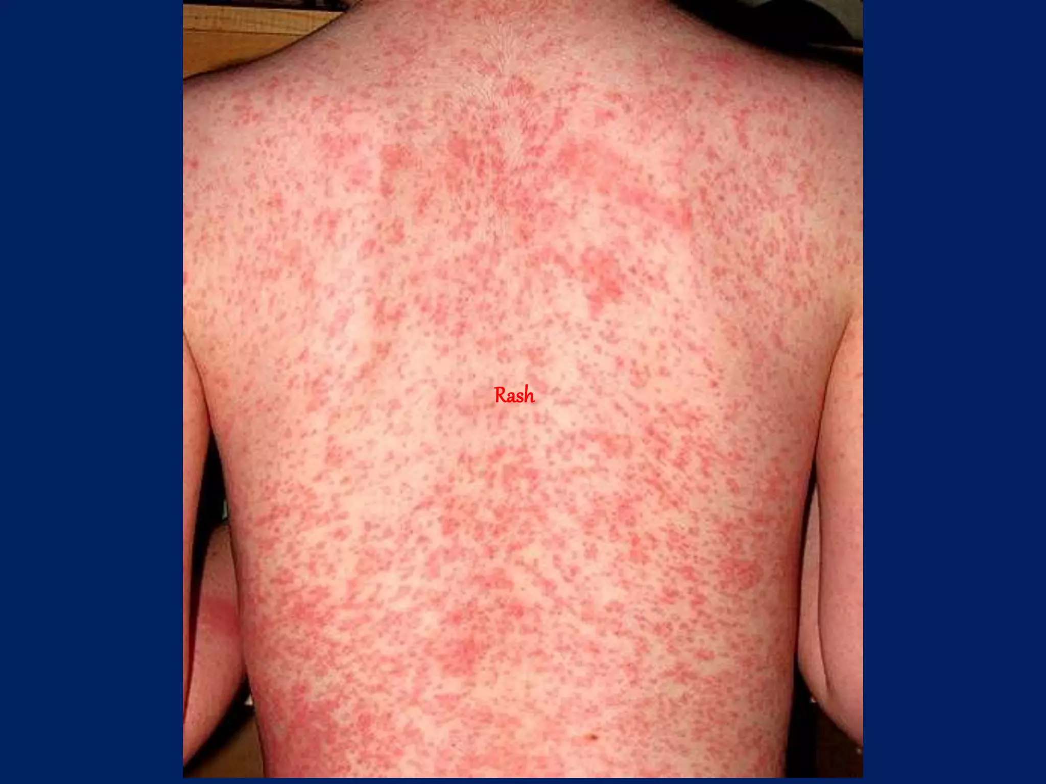 ectodermal dysplasia and white spongy nevus.ppt | Skin and Dermatology ...