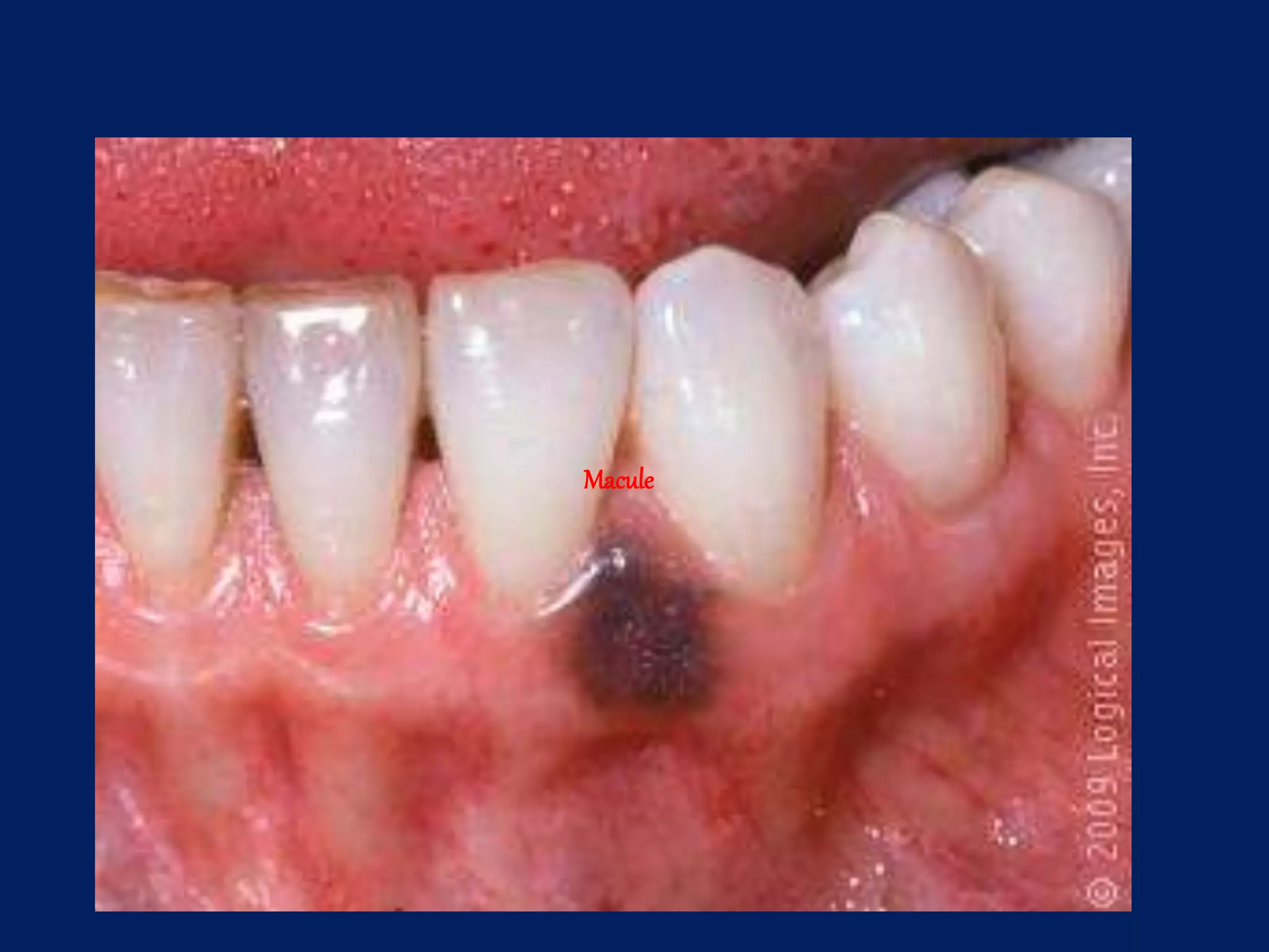 ectodermal dysplasia and white spongy nevus.ppt | Skin and Dermatology ...