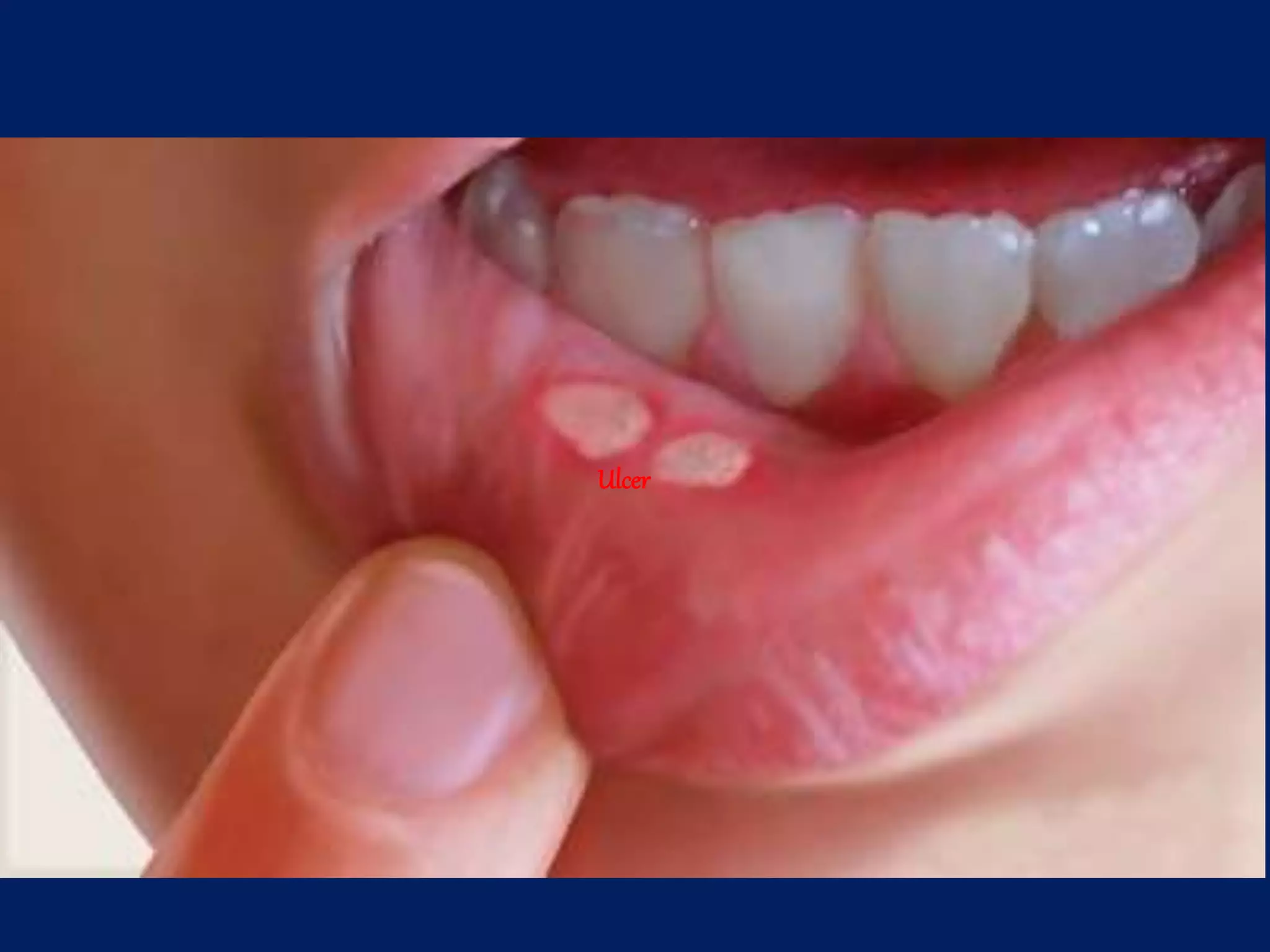 ectodermal dysplasia and white spongy nevus.ppt | Skin and Dermatology ...