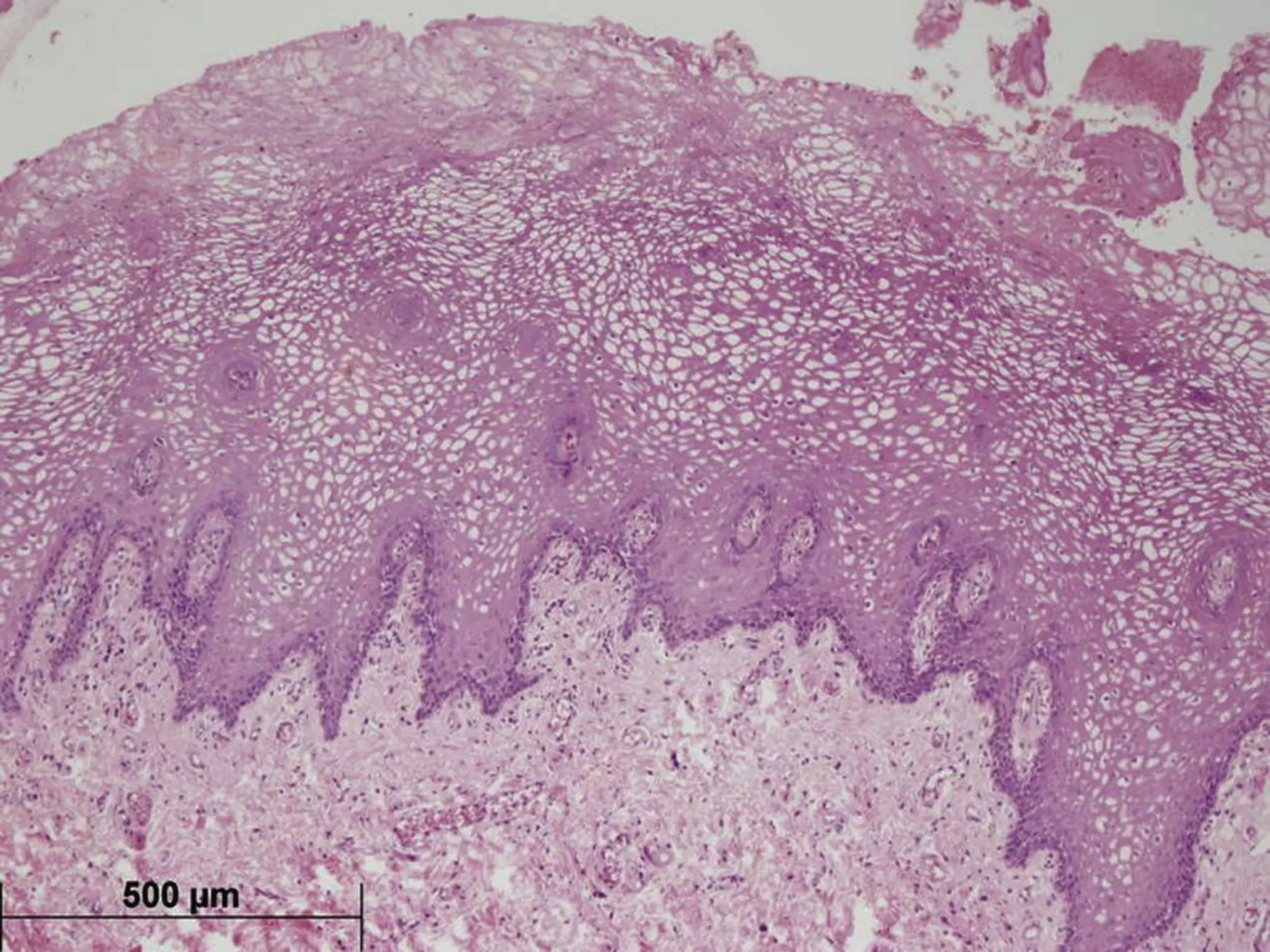 ectodermal dysplasia and white spongy nevus.ppt | Skin and Dermatology ...