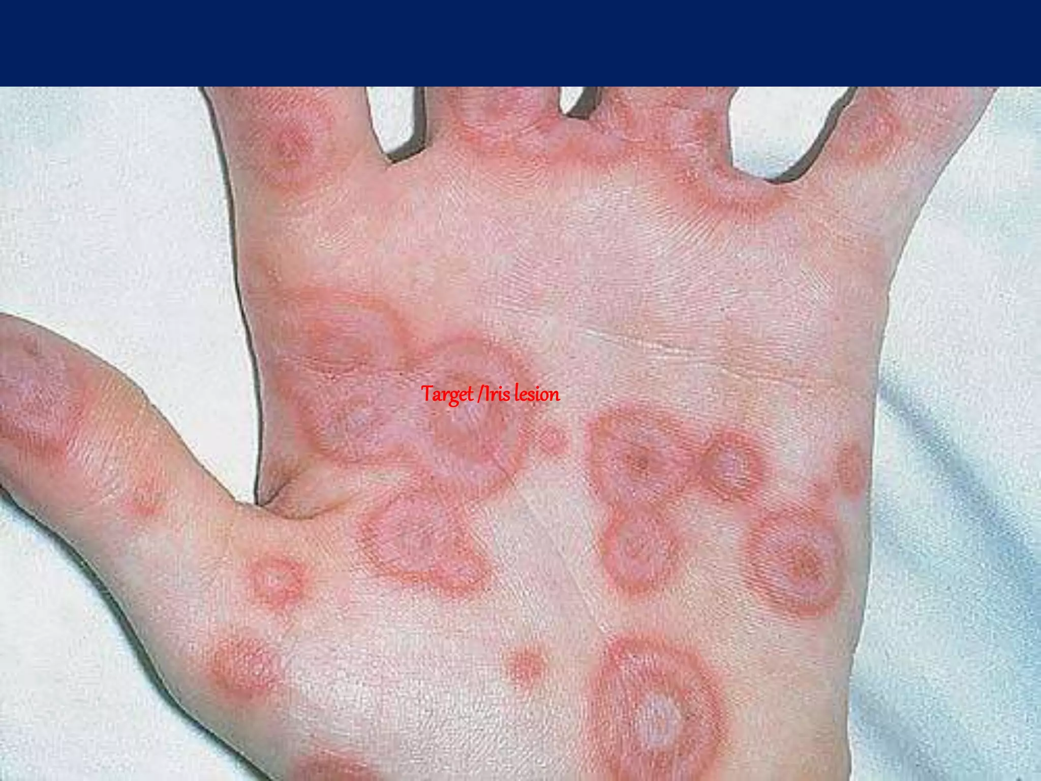 ectodermal dysplasia and white spongy nevus.ppt | Skin and Dermatology ...