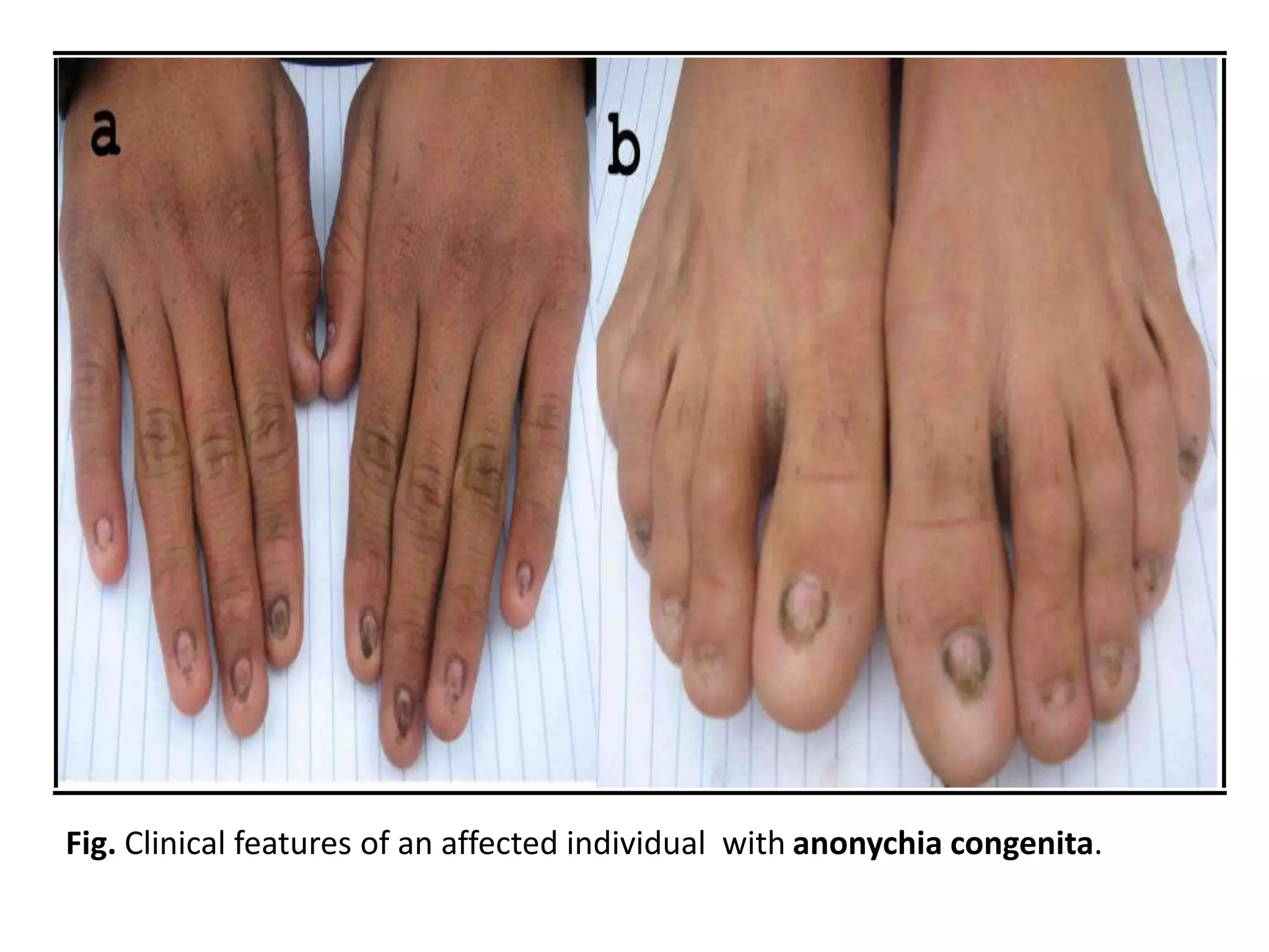 ECTODERMAL DYSPLASIAS | Genetic Disorder | PPTX