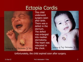 Ectopia Cordis Case Report PPT.pdf