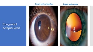 Ectopia lentis classification and management | PPTX