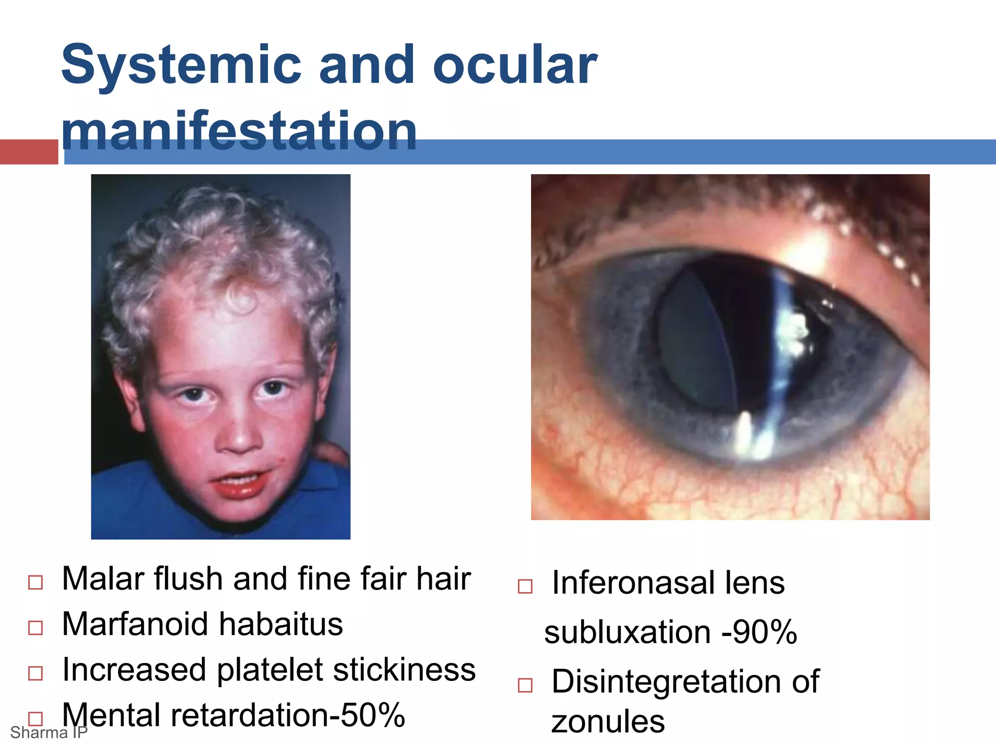 Ectopia lentis and its low vision management | PPTX | Eye and Vision ...