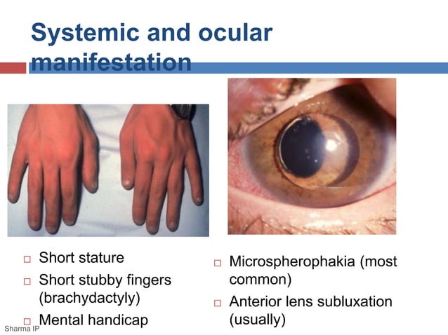 Ectopia lentis and its low vision management | PPTX | Eye and Vision ...
