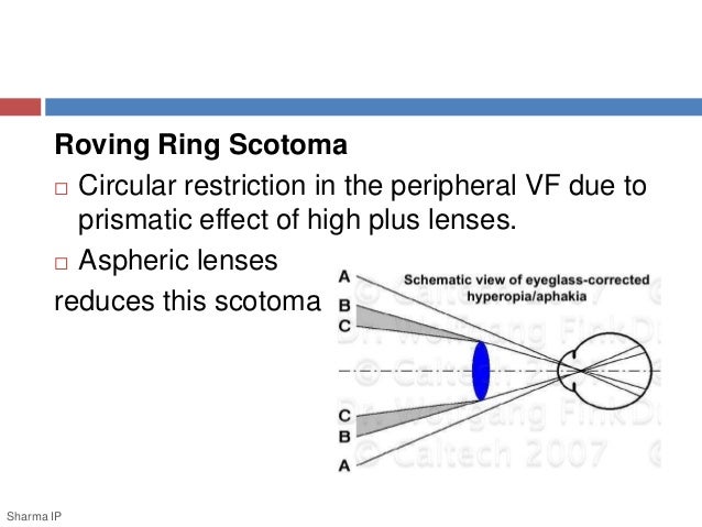 Ectopia lentis and its low vision management