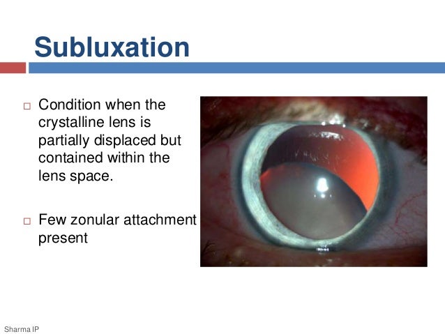 Ectopia lentis and its low vision management