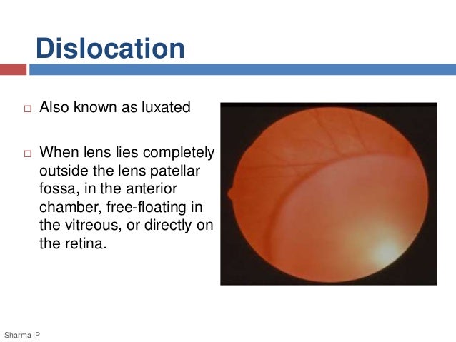 Ectopia lentis and its low vision management