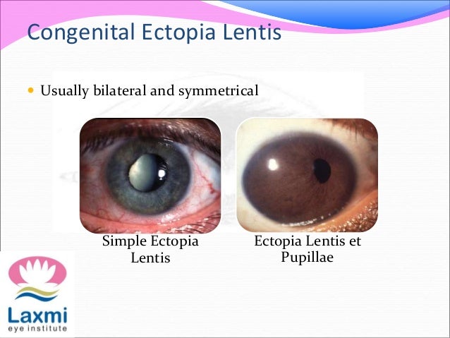 Ectopia lentis edit