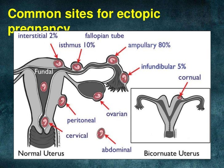 Ectopic Pregnancy