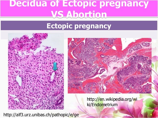 Normal Vs Ectopic Pregnancy
