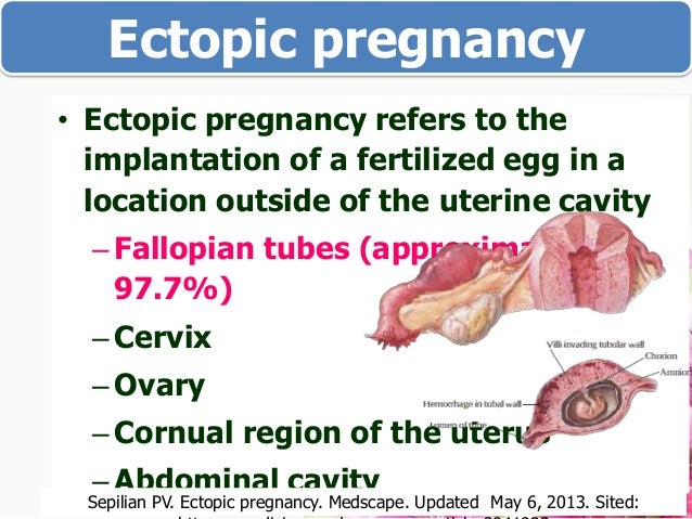 Ectopic pregnancy PBL